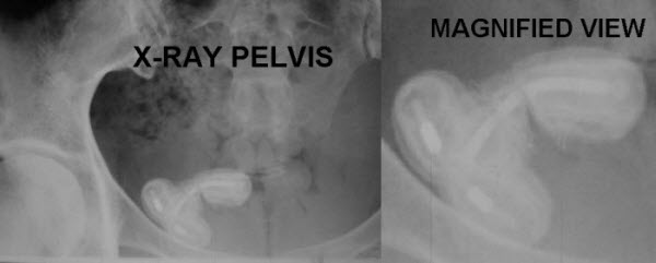An Unusual Vesical Calculus | Amin | Journal of Radiology Case Reports