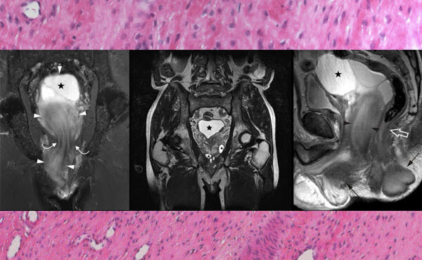 Radiographic diagnosis and differentiation of an aggressive angiomyxoma ...
