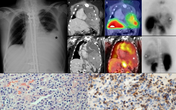 Nuclear scintigraphy findings for Askin tumor with In111-pentetreotide ...