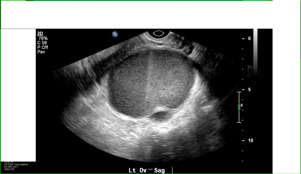 Sonographic Features Of Tubo Ovarian Abscess Mimicking An Endometrioma