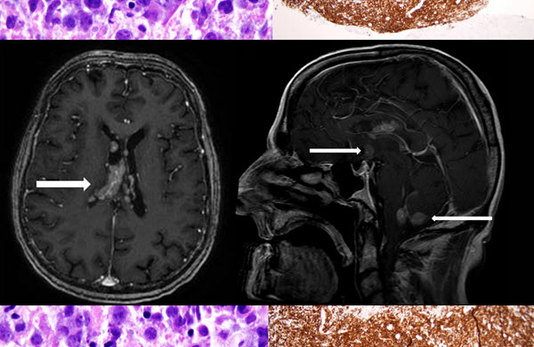 A Case of Intraventricular Primary Central Nervous System Lymphoma ...