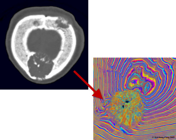 Metastatic Deposit In The Skull | Fung | Journal of Radiology Case Reports