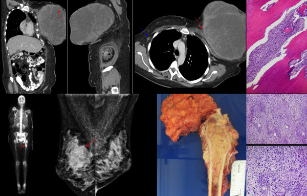 Unusual Aggressive Breast Cancer Metastatic Malignant Phyllodes Tumor