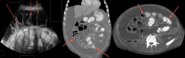 Sclerosing Encapsulating Peritonitis (Cocoon Bowel) Presenting after ...
