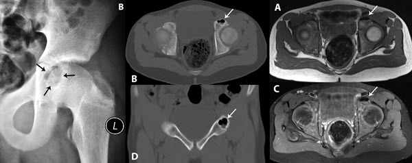 Incidental Intraosseous Pneumatocyst with gas-density-fluid level in an ...