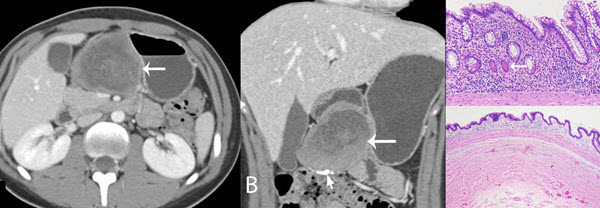 Isolated duodenal duplication cyst presenting as a complex solid and ...
