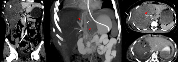 Traumatic Portacaval Shunt: A Case Report and Literature Review ...