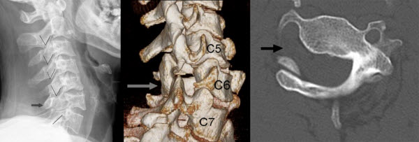 The Role Of Ct Imaging In The Congenital Absence Of A Cervical Spine
