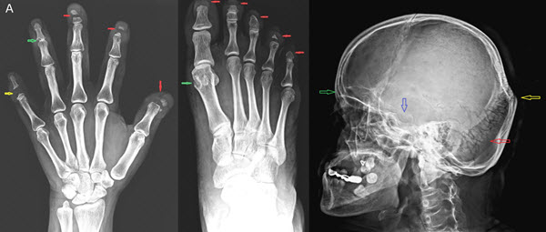 Hajdu-Cheney Syndrome: A case report with review of literature | Palav ...