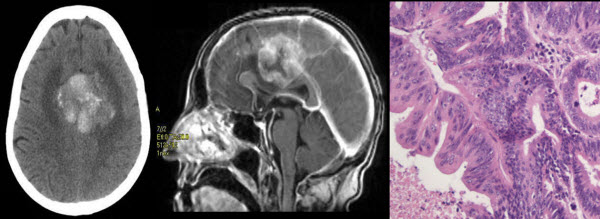 Dural Based Mass: Malignant or Benign | Scherer | Journal of Radiology ...