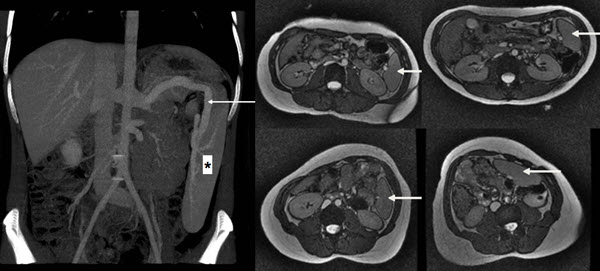 Dynamic MRI in the Diagnosis and Post Surgical Evaluation of Wandering ...