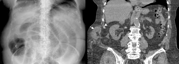 Incarcerated Grynfeltt-Lesshaft Hernia | Scheffler | Journal of ...