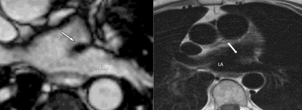 The Coumadin Ridge: An Important Example of a Left Atrial Pseudotumour ...
