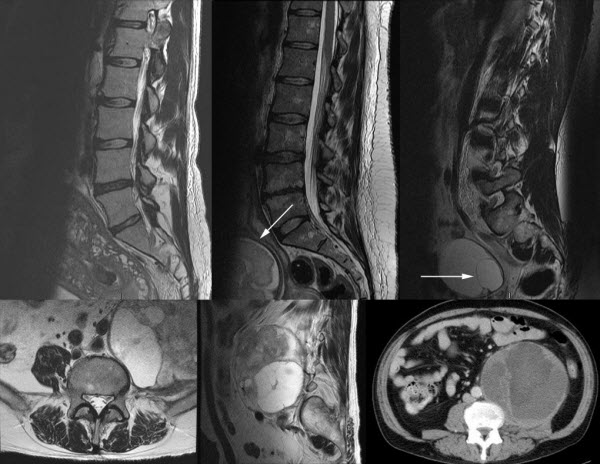 Extraspinal Findings On Lumbar Spine Mr Imaging Gebara Journal Of Radiology Case Reports