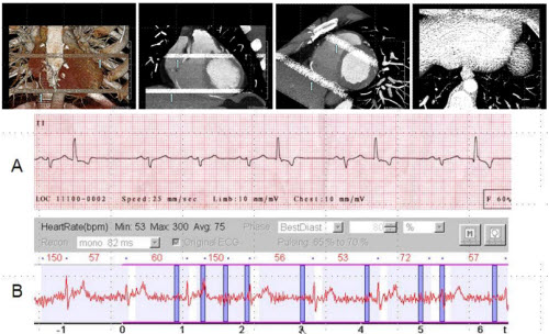 Banding and Step-Stair Artifacts on the Cardiac-CT Caused By Pseudo ...