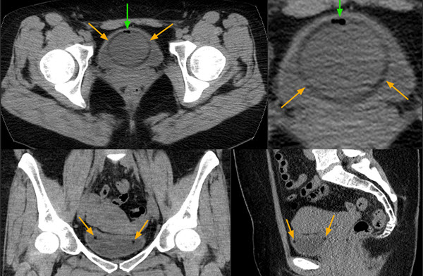 Inadvertent intravesicular placement of a vaginal contraceptive ring: a ...
