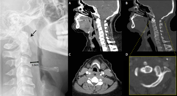 Acute Prevertebral Calcific Tendinitis | Tamm | Journal of Radiology ...
