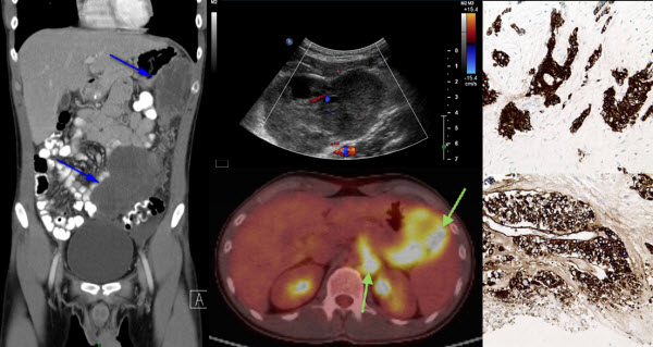 A Case of Desmoplastic Small Round Cell Tumor | Reisner | Journal of ...