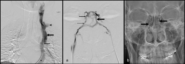 Role of bilateral inferior petrosal sinus sampling (BIPSS) in the ...