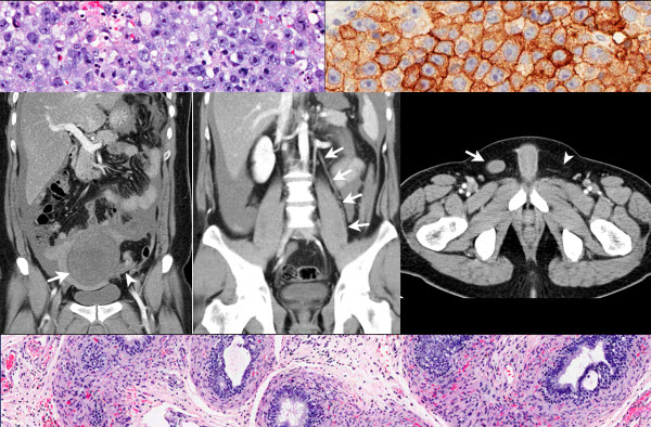 A Torted Ruptured Intra Abdominal Testicular Seminoma Presenting As An