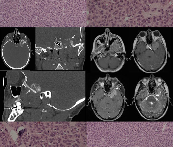A rare case of atypical skull base meningioma with perineural spread ...