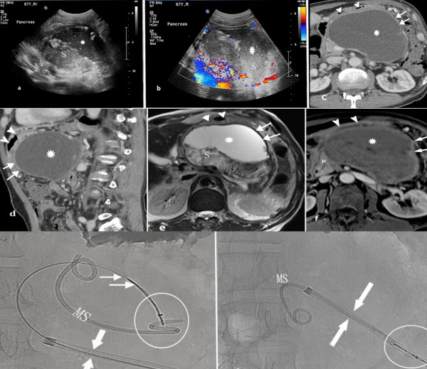 Percutaneous Approach for Removal of a Migrated Cystogastric Stent from ...