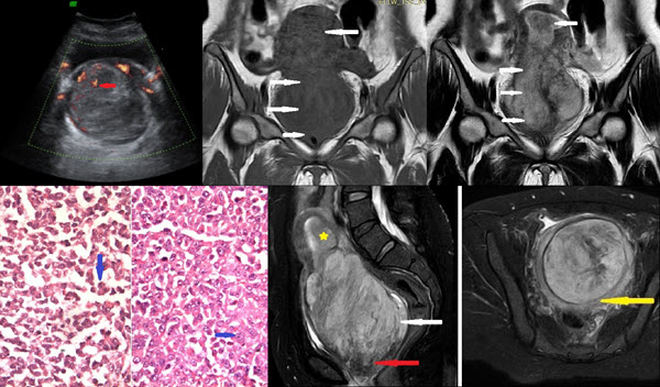 Endometrial stromal sarcoma: An aggressive uterine malignancy | Adiga ...