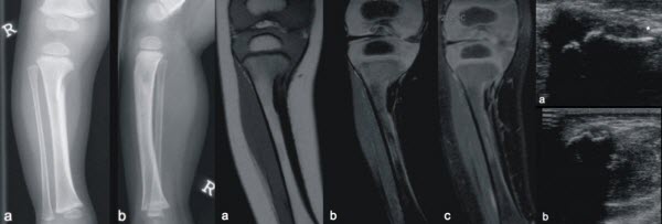 Unilateral tibia vara in a toddler caused by focal fibrocartilaginous ...