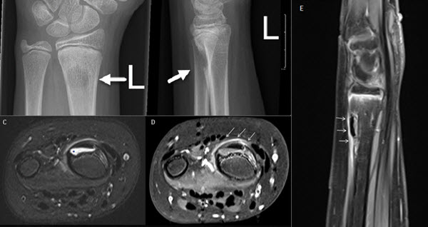 Paediatric post-traumatic osseous cystic lesion following a distal ...