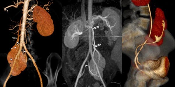 Duplex Kidney Collecting System Xray Stock Image