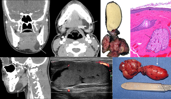 Floor Of Mouth Dermoid Cyst Radiology