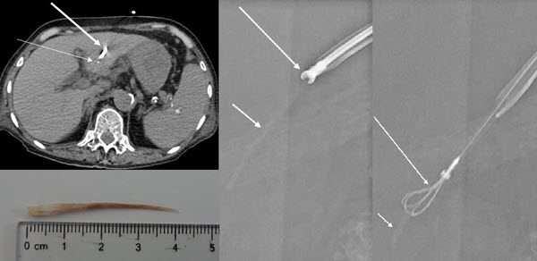Image-guided Percutaneous Transhepatic Removal of Fish Bone from Liver ...
