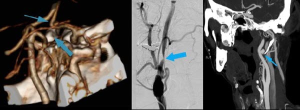 Vascular Eagle's Syndrome: Two Cases Illustrating Distinct Mechanisms ...