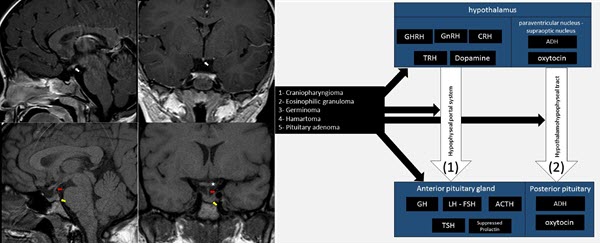 The Missing Link: A Case of Absent Pituitary Infundibulum and Ectopic ...
