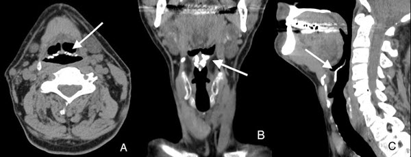 Calcification of the epiglottis presenting as foreign body sensation in ...