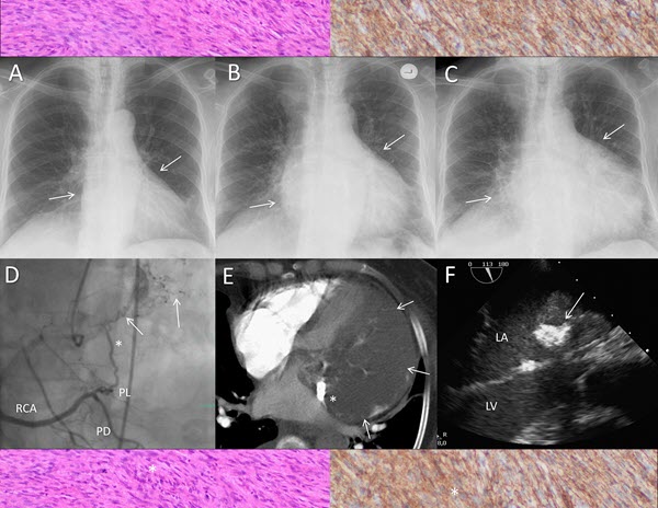 Multimodal Imaging for the Assessment of a Cardiac Mass - A Case of ...