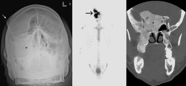 A Case of Craniofacial Polyostotic Fibrous Dysplasia | Clark | Journal ...