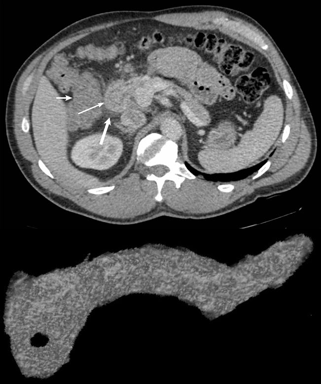 Annular Pancreas In An Adult Presenting With Acute Pancreatitis