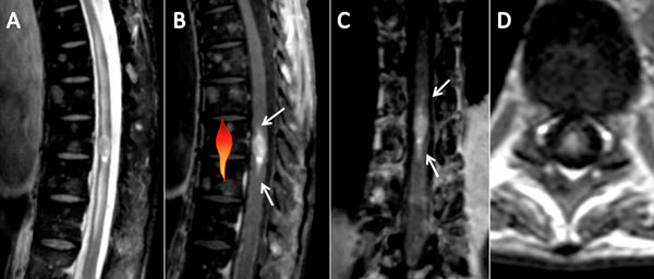 An intramedullary "flame" recognized as being an intramedullary spinal ...