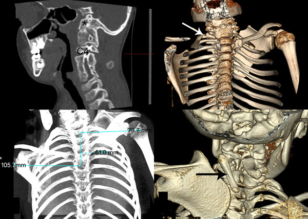 Klippel-Feil Syndrome with Sprengel Deformity | Georgiev | Journal of ...