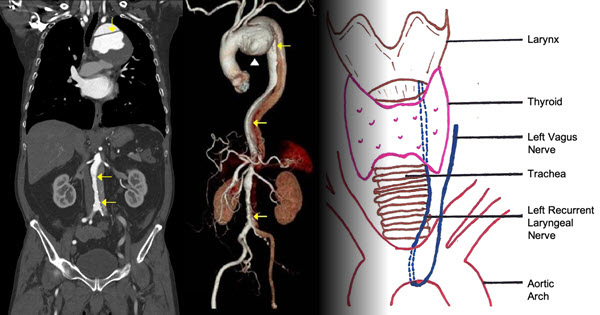 A Case of Hoarseness with Acute Back Pain - Cardiovocal Syndrome ...