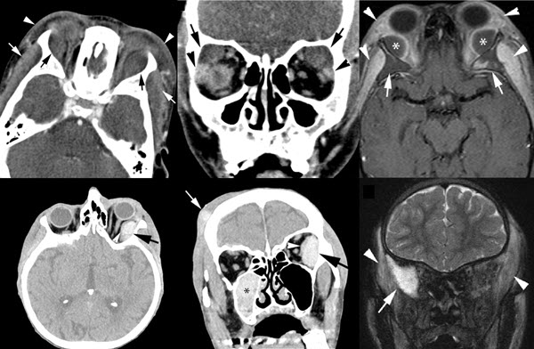 Subperiosteal Hematoma of the Orbit: A Variety of Presentations ...