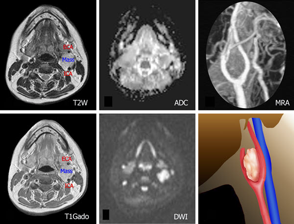 Carotid body tumor: a case report and literature review | Hoang ...