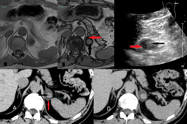 Adrenal Adenoma-Hemangioma Collision Tumor: Description of Two Cases ...