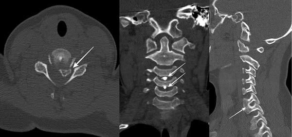 Intervertebral Disc Calcification and Klippel-Feil Syndrome | Cole ...