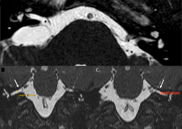 Internal auditory canal hypoplasia associated with bilateral ...