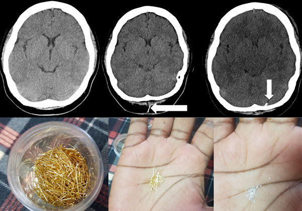 The Wandering Charm Needle | Chekenyere | Journal of Radiology Case Reports