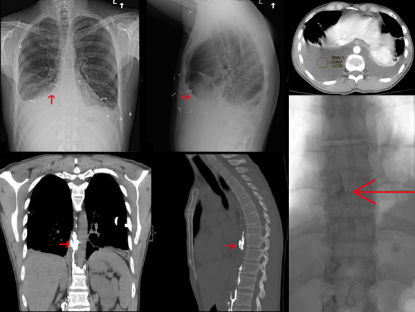 Isolated thoracic duct injury from blunt force trauma | Champion ...
