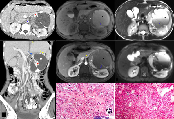 Alveolar soft part sarcoma of the retroperitoneum: A case report ...