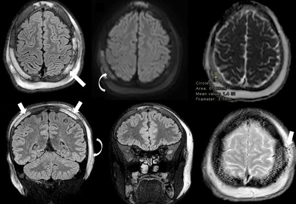 Acute soft head syndrome in a sickle cell disease patient | Zadeh ...